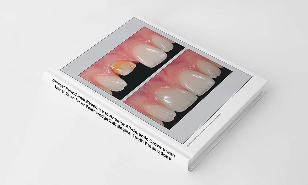 Clinical Periodontal Response to Anterior All-Ceramic Crowns with ...